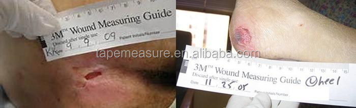15 18cm Wound Measuring Paper Ruler, High Quality 15 18cm Wound ...