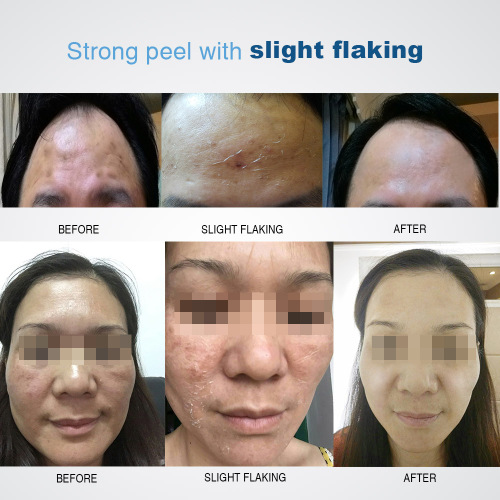 Anti Pigmentation Aha&bha Skin Peeling Solutions, High Quality Anti ...