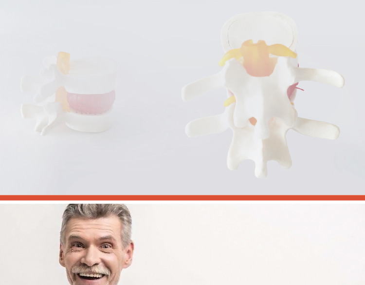 Lumbar Disc Herniation Model Frt039 - Human Lumbar Vertebral Spine ...