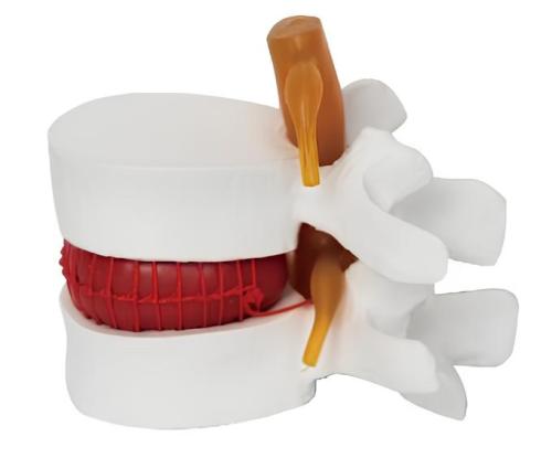 Herniated Disc Herniation Model, High Quality Herniated Disc Herniation ...