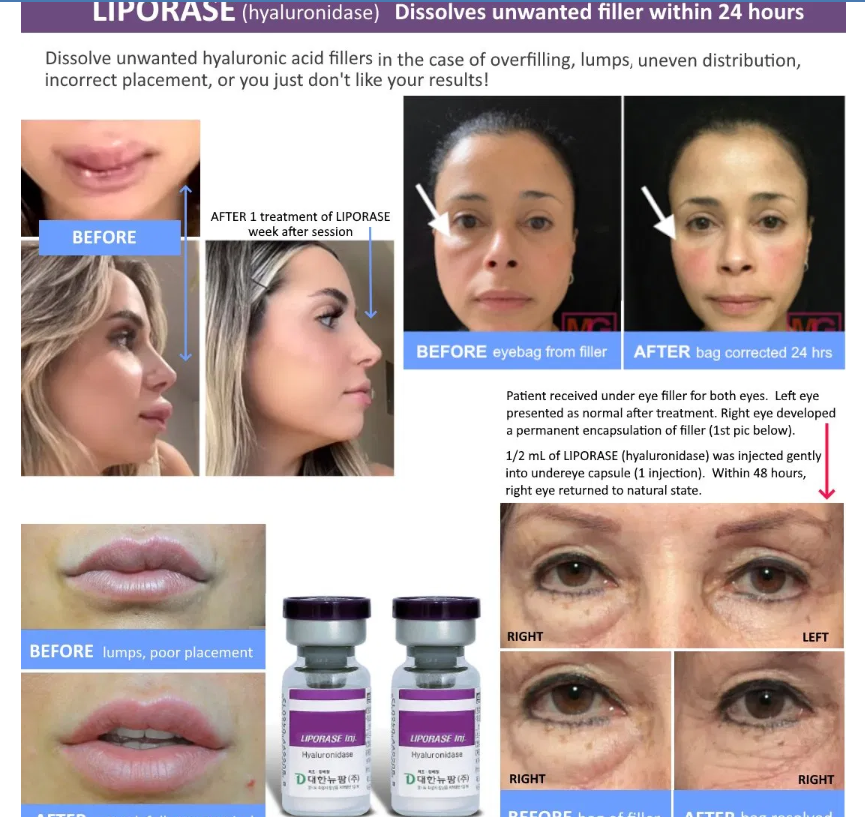 Liporase - Hyaluronidase 1 ขวด, 1,500 Iu ละลายฟิลเลอร์ผิวหนัง ...
