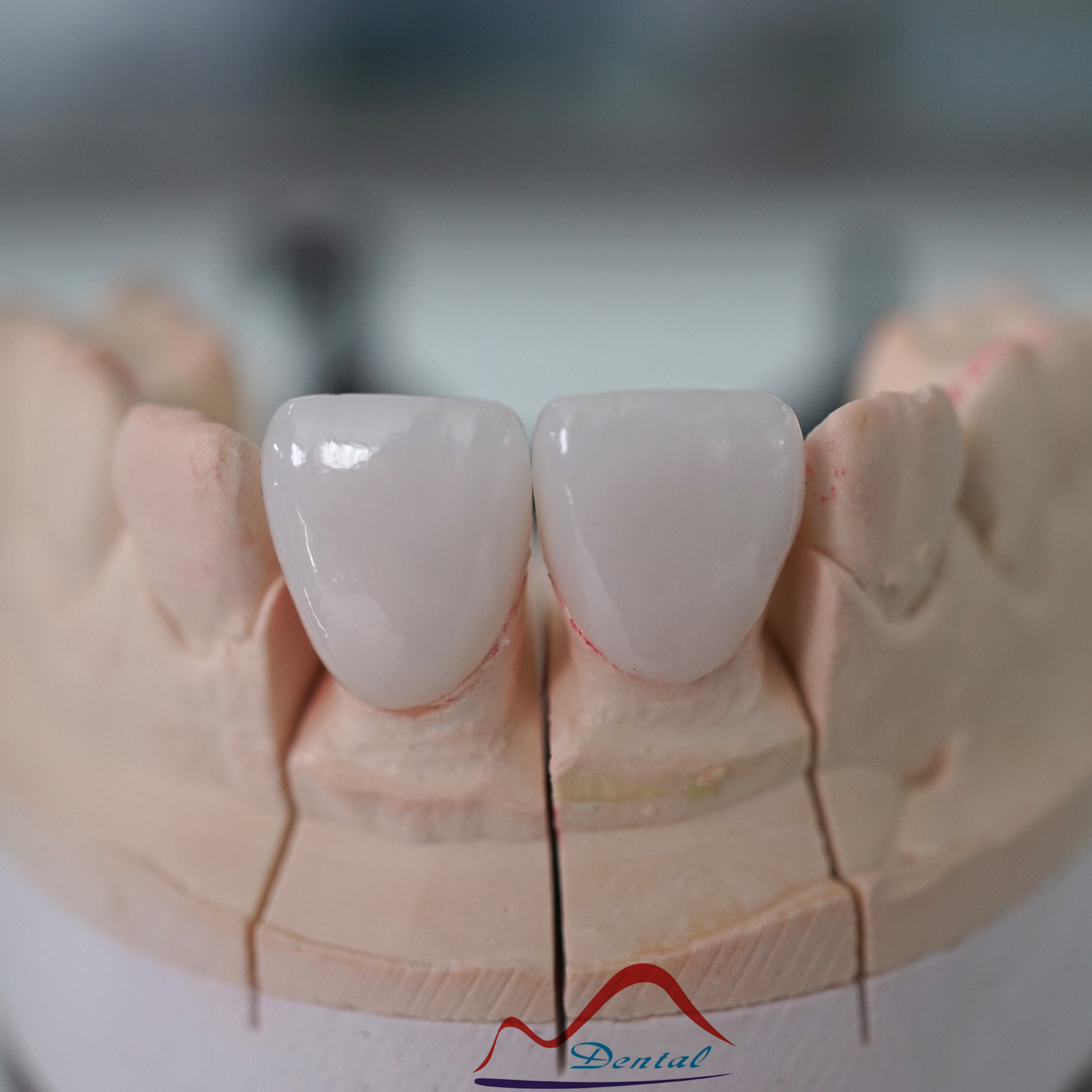 치과 인시저 Emax Crowns, Bossgoo.com의 고품질 치과 인시저 Emax Crowns