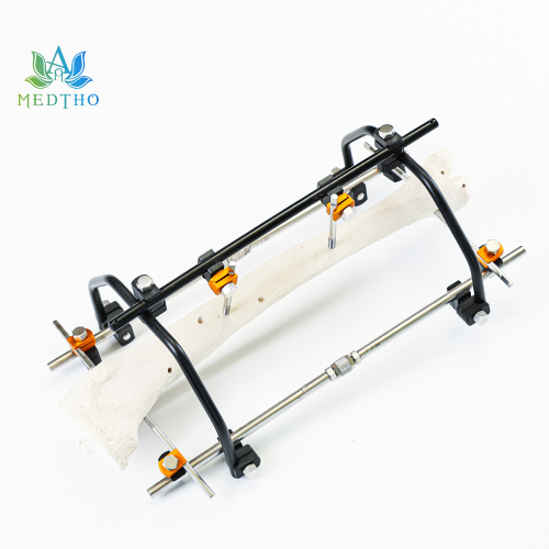 Tibia Ex Fix, High Quality Tibia Ex Fix on Bossgoo.com