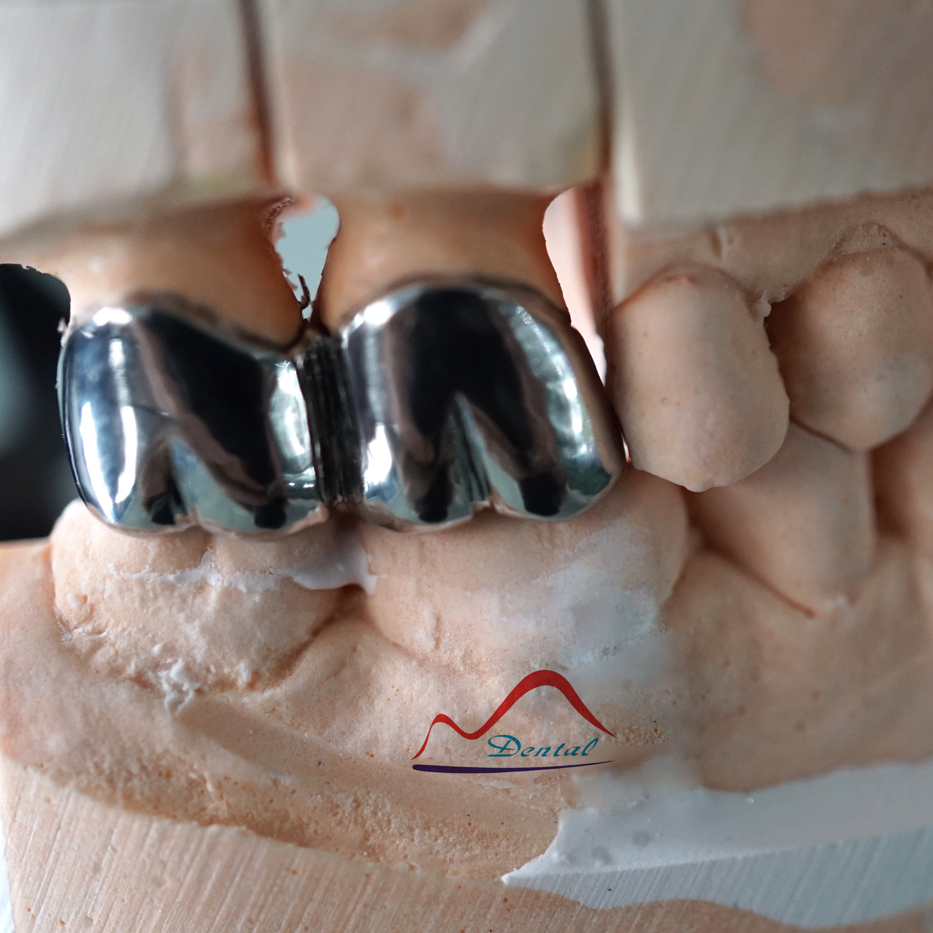 Dental Full Metal Bridge, High Quality Dental Full Metal Bridge on ...