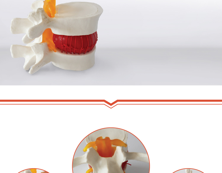 Lumbar Disc Herniation Model Frt039 - Human Lumbar Vertebral Spine ...