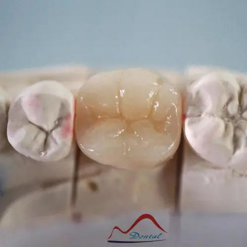 고품질 Emax Onlay, Bossgoo.com의 고품질 고품질 Emax Onlay