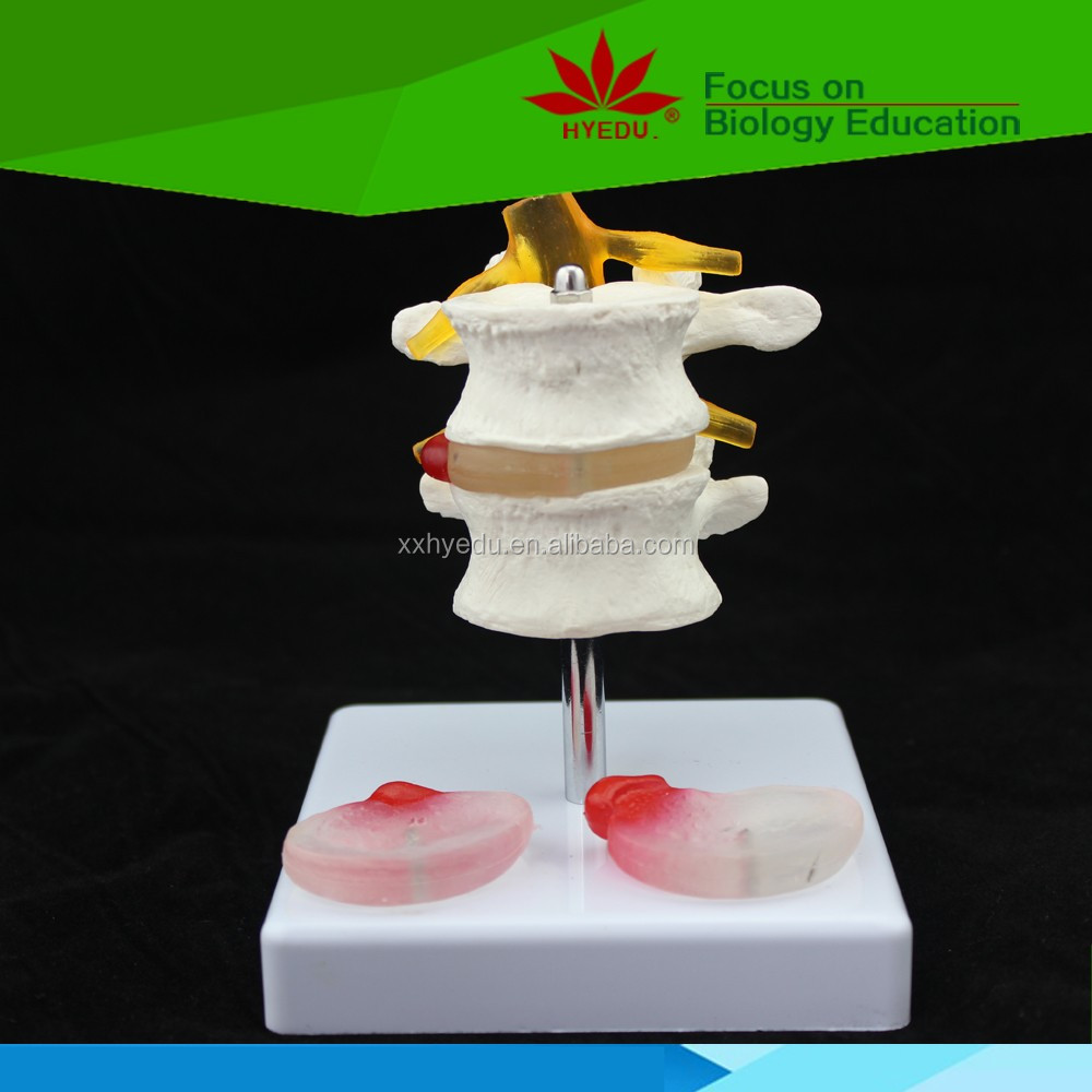 Lumbar Vertebral Model With Hernia And Prolapsed Disc For Medical ...
