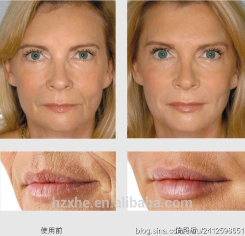 Cosmetic Facial Injection Beauty Injection Injectable Derm Filler, High ...
