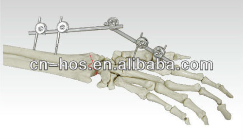 Radius Far End Fracture External Fixation, High Quality Radius Far End ...