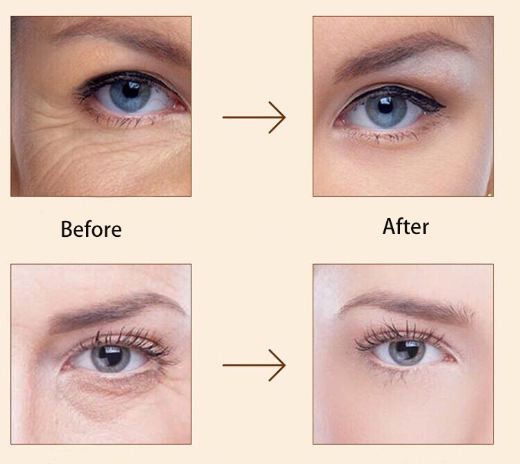 Shangyang High Pressure Needleless Lip Filler For Electric Automatic ...