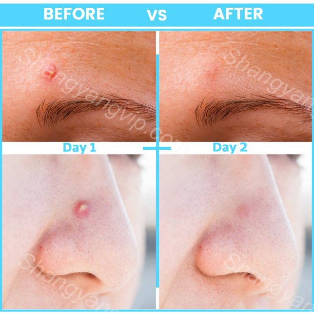 Wholesale Hydrocolloid Acne Healing Pimple Patch Acne Cover Patch ...