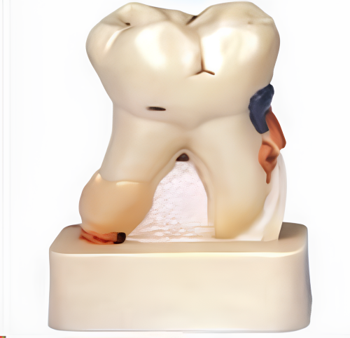 Dissected Of Dental Disease, High Quality Dissected Of Dental Disease ...