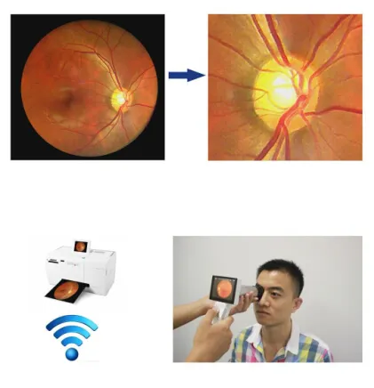 Portable Digital Retinal Camera For Fundus Imaging Screening, High ...