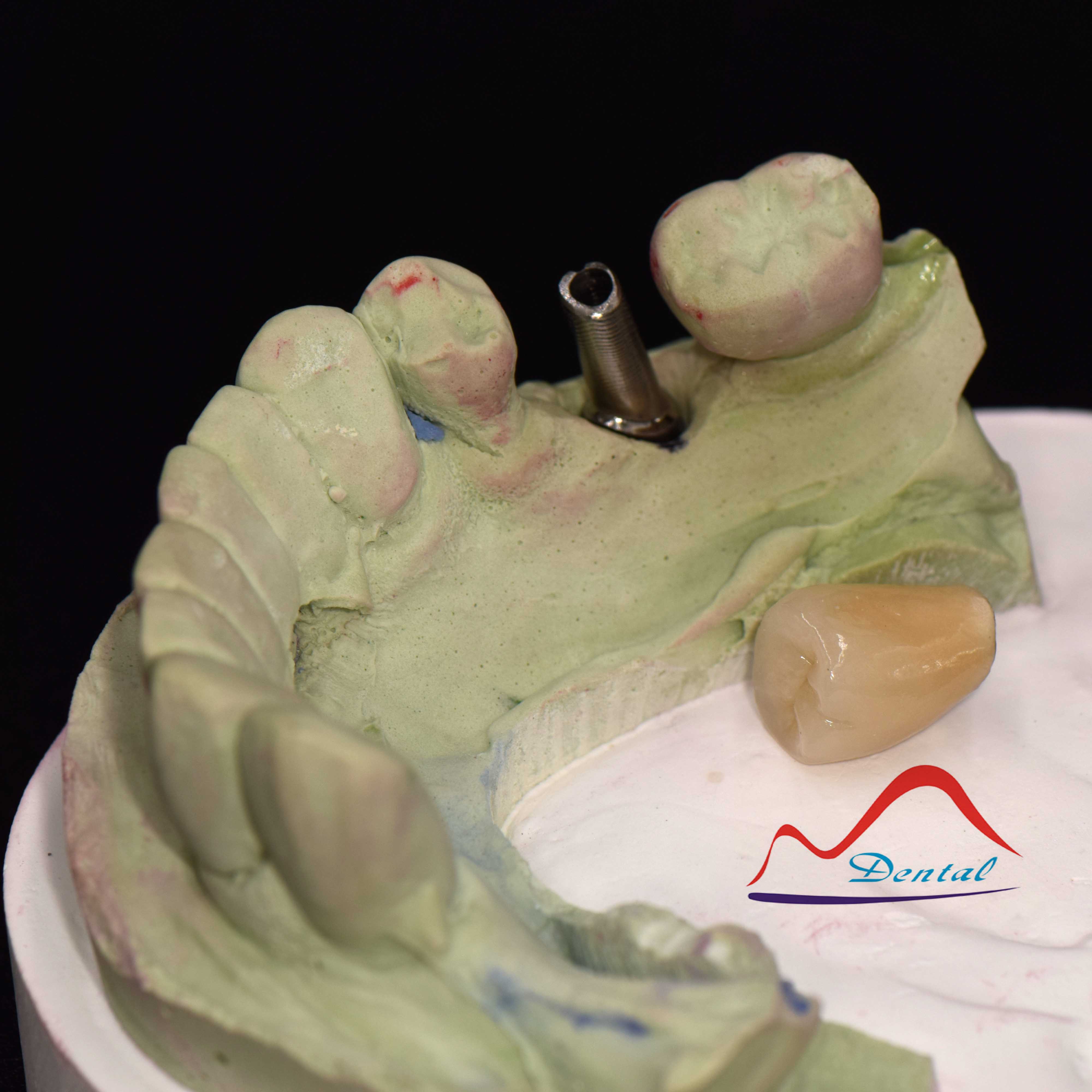 Cement Retained Cocr Implant, High Quality Cement Retained Cocr Implant ...