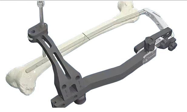 Application of PEEK in medical device industry