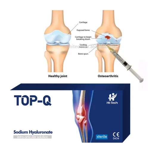 2.5ml Non Cross Linked Hyaluronic Acid Gel Knee Joint Injection, High ...