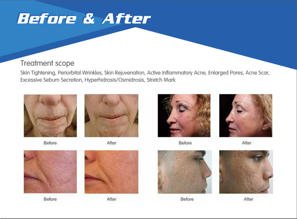 Fractional Radio Frequency Micro Needling, High Quality Fractional ...