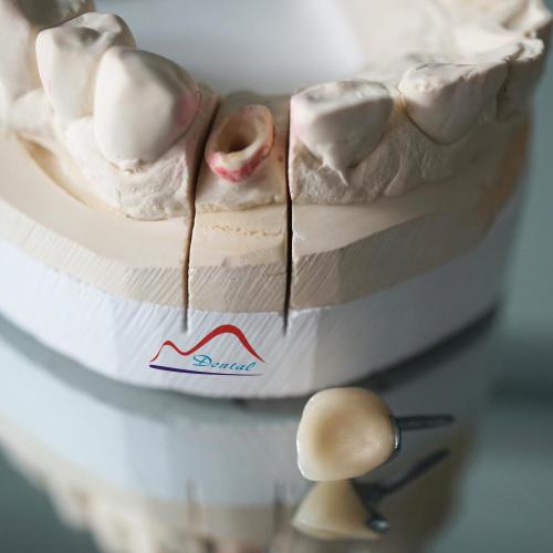 Corona Dentales De Richmond Única, alta calidad Corona Dentales De ...