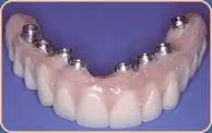 Flexible Dental Implant Prosthetics With Perfect Fit For Removable ...