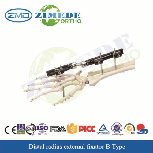 Distal Radius External Fixator B Type Of Type Of Dispoable External ...