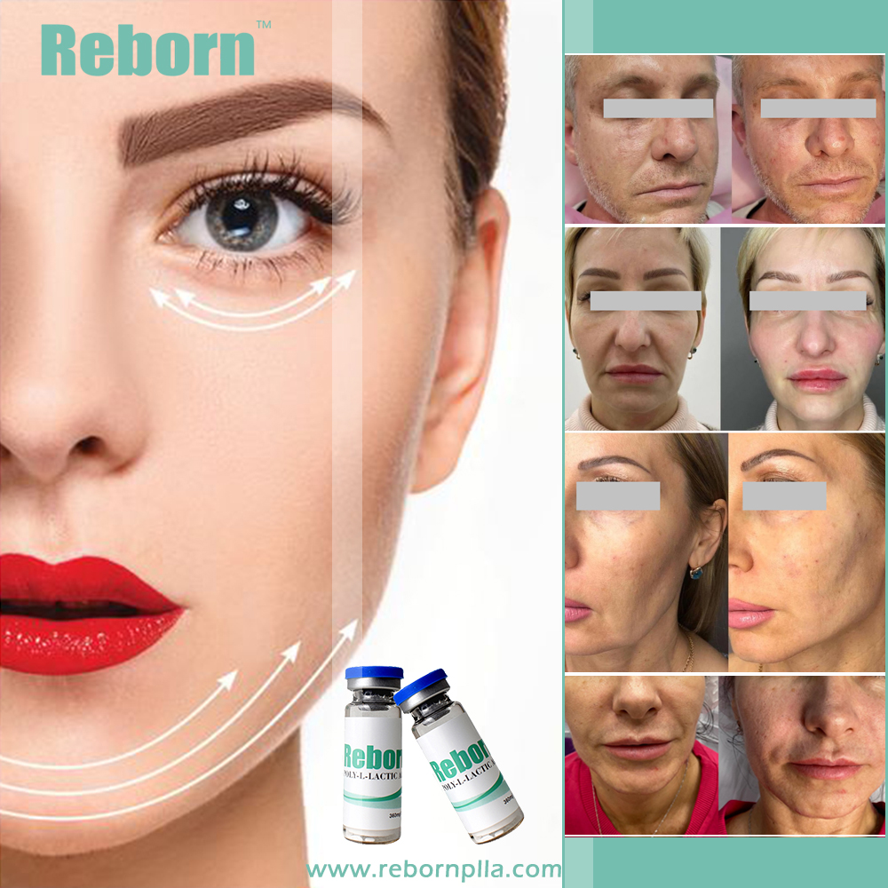 Reborn Plla Anti Aging Filler For Medical Beauty Clinic Use, High Quality Reborn Plla Anti Aging ...