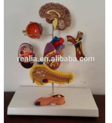 Diabetes Model, High Quality Diabetes Model on Bossgoo.com
