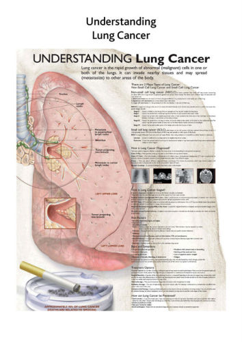 3d Medical Chart-understanding Lung Cancer, High Quality 3d Medical ...