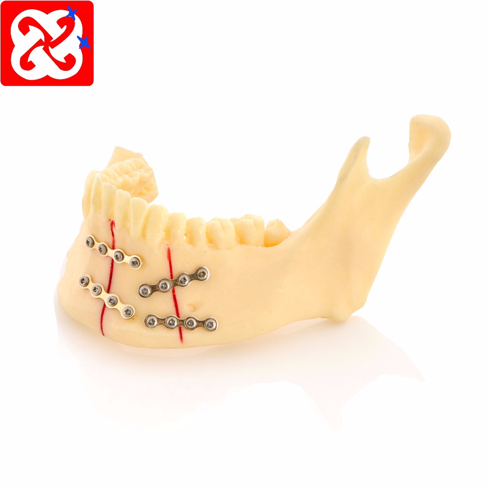 Dental Model Demonstrating Jaw Fracture Restoration With Plate Fixation ...